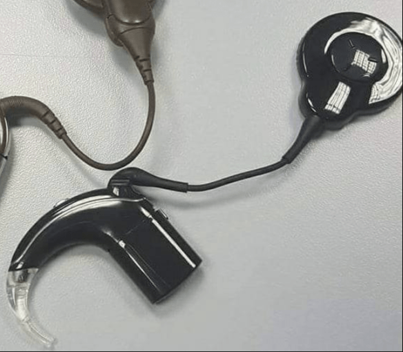 Nucleus 7 Spy Photo | cochlear implant HELP