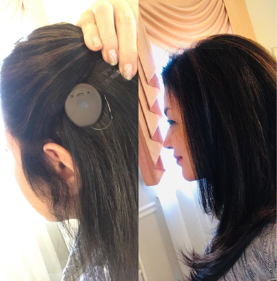 Cochlear Kanso 2 Processor Review | cochlear implant HELP